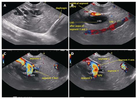 Common Hepatic Duct Ultrasound