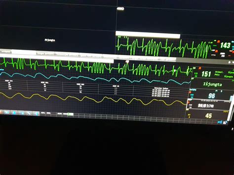 Self Terminating Ventricular Tachyarrhythmia Didnt End Well Tho Recg