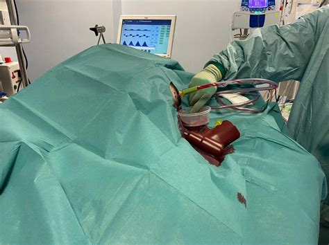 Drainage Of An Extradural Haematoma By Intraosseous Needle In A Remote