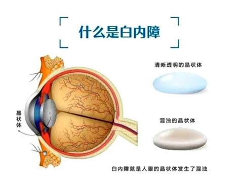 白内障成熟才能做手术？错啦！晶状体治疗视力