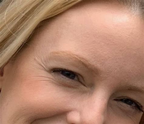 Bleph Vs Brow Lift Vs Waiting It Out R Plasticsurgery