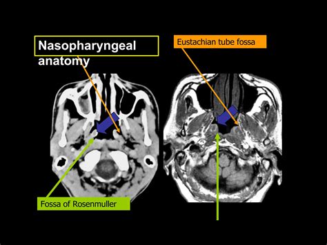 All About Detaled Description Parapharyngeal Spaces Pptx