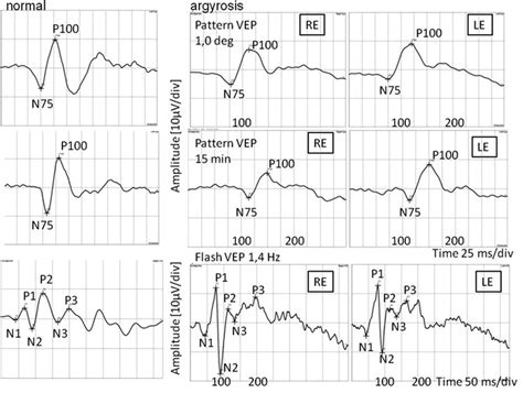 Pattern And Flash Vep Re Right Eye Le Left Eye Pattern Vep P100 Download Scientific Diagram