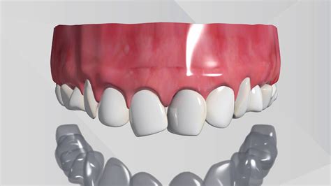 Invisalign 3d Animation Youtube