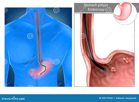 Gastric Polyps Stomach Upper Endoscopy Stock Vector Illustration Of