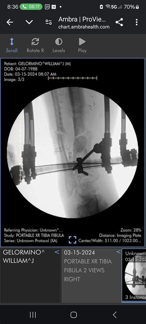 External Fixator Rbrokenbones