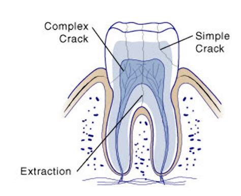 Cracked Tooth Syndrome Firstbite Dental Essendon Dentist