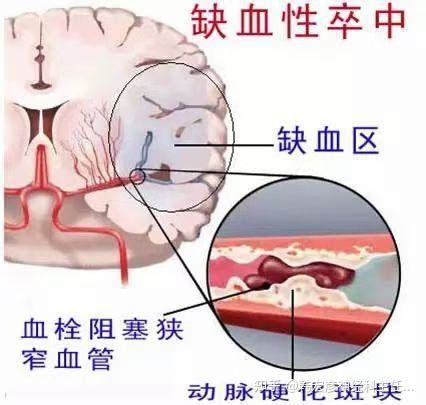 什么是缺血性脑卒中及分型 知乎