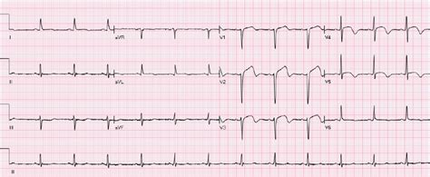 Spontaneously Reperfused STEMI There Is ST Elevation With Terminal T Download Scientific