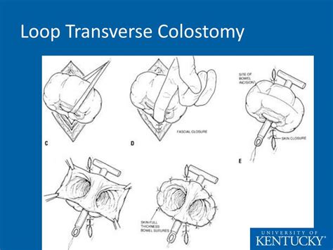 Ppt The Difficult Stoma Powerpoint Presentation Free Download Id