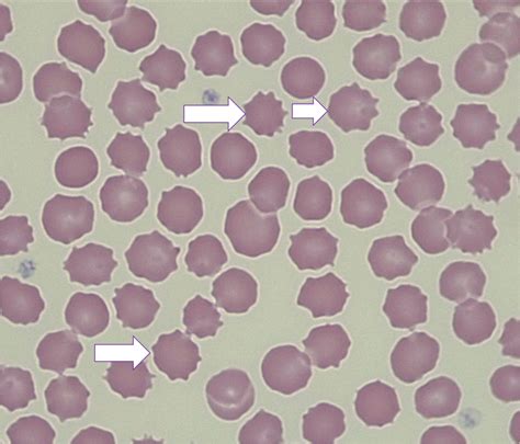 3 Eritrocitos Poiquilocitosis Patología Clínica Veterinaria