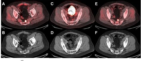 Figure 1 From Lymph Node Dissection Following Radical Prostatectomy Semantic Scholar