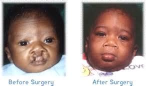 Free Of Cost Cleft Lip Palate Surgery Operation Globalgiving
