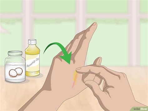 Ways To Get Rid Of Scars WikiHow Narben Akne Akne Hausmittel