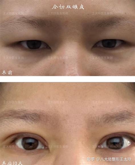 肿泡眼双眼皮术后效果反馈 知乎