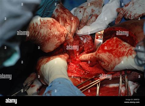 Pictured Is A Man Undergoing Surgery To Remove Fibrosarcoma