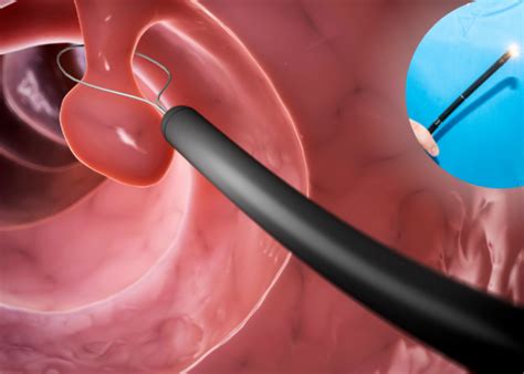 Advanced Gi Endoscopy Surat Gestro Center