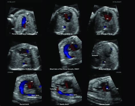 Application Of Color Doppler Fetal Intelligent Navigation Download Scientific Diagram