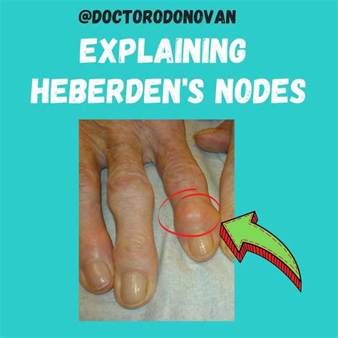 Hand Exercises For Heberdens Nodes At Ronald Caster Blog