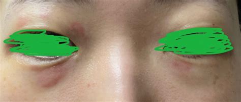 눈 주위 붉은 얼룩 지식in