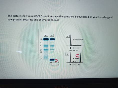 This Picture Shows A Real SPEP Result Answer The Chegg Com
