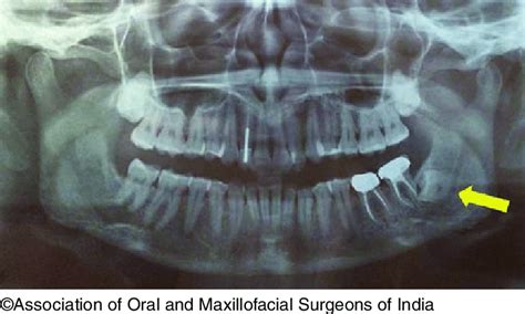 16 Opg Showing Impacted Mandibular Third Molar Displaying Only Crown Of