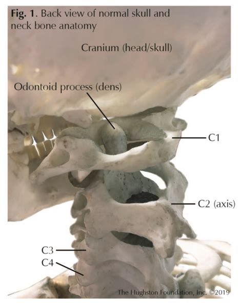 Odontoid Fractures Hughston Clinic