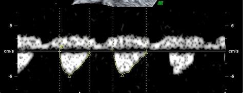 The Umbilical Artery Doppler Tracing And Measurement Of Pulsatility Download Scientific Diagram