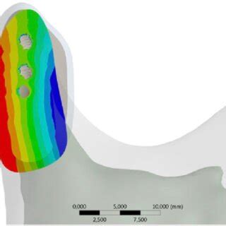 Finite Element Model Of A Mandible With A Right Sided Type P Condylar Download Scientific