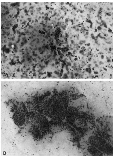 Benign Lesions A Colloid Goiter Small Cell Cluster With