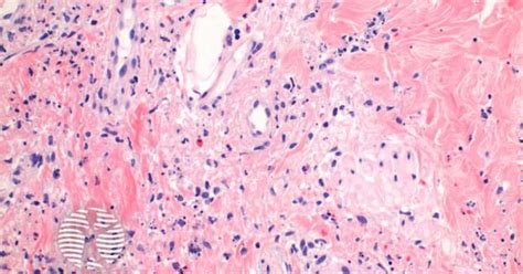 Leukocytoclastic Vasculitis Pathology Image