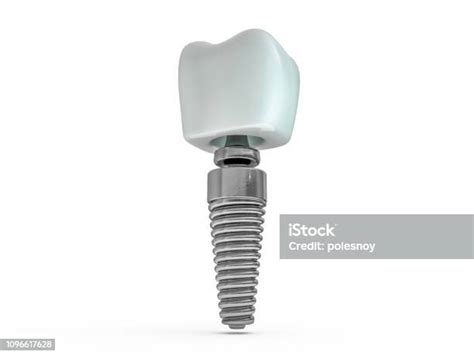 치과 임 플 란 트 치과 치아 레이아웃 플라스틱 남자 치아 치료 3d 3차원 형태에 대한 스톡 사진 및 기타 이미지 3차원 형태 강철 건강관리와 의술 Istock