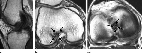 Four Strand Hamstring Graft A Sagittal Proton Density Weighted Fast Download Scientific