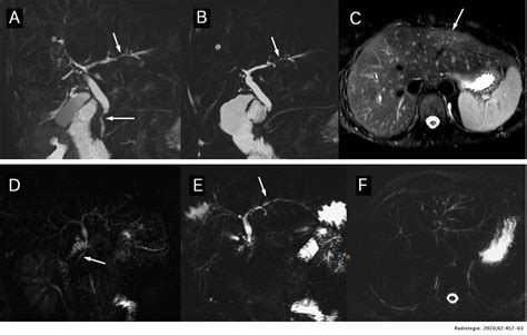 Chronic Cholangitis Differential Diagnosis And Role Of Mri