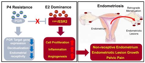 The Main Theories On The Pathogenesis Of Endometriosis Pubmed