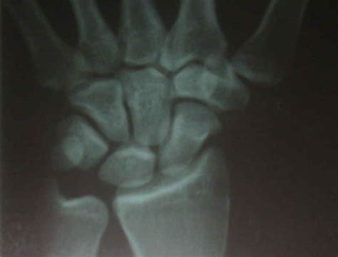 Fracture Through Proximal Third Of The Scaphoid Wheeless Textbook Of Orthopaedics