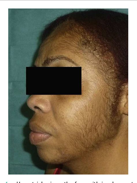 Hypertrichosis Treatment Before And After