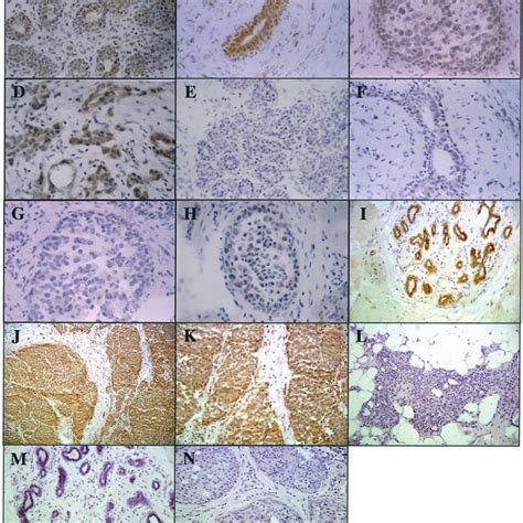 Effect Of Breast Fibroblast CM On Epithelial And Myoepithelial Cell