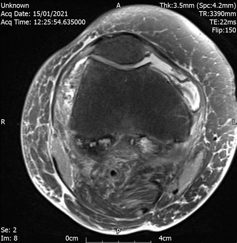 Knee Synovitis Cases Home