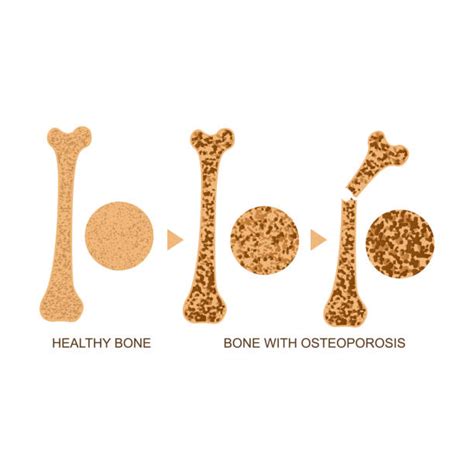 1800 Osteoporosis Fracture Stock Illustrations Royalty Free Vector