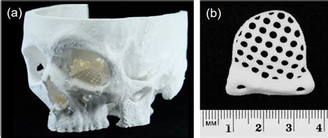 Patient Specific Implants Made Of 3d Printed Bioresorbable Polymers At