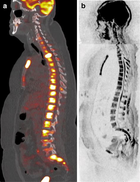 A year old woman with R ISS stage Lambda Light Chain MM ¹⁸F FDG Download Scientific