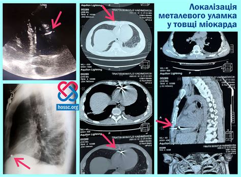 Уламок міни з серця військового дістали кардіохірурги в Хмельницькому XМ ІНСАЙД