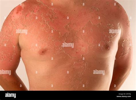 Erythema Solar Hi Res Stock Photography And Images Alamy