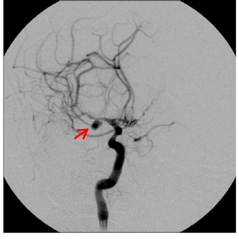 2d Cerebral Dsa Image With Csa At The Right Middle Cerebral Artery Download Scientific Diagram