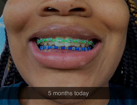 Pin On Braces Colors