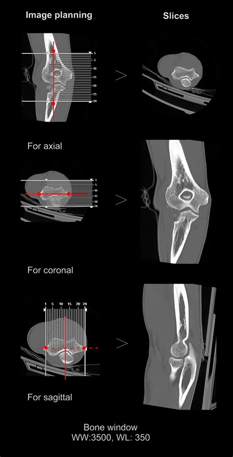 Ct Scan Elbow Joint Ct Elbow Positioning