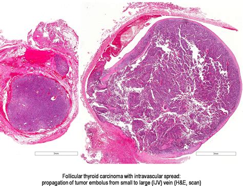 Pathology Outlines Follicular Thyroid Carcinoma