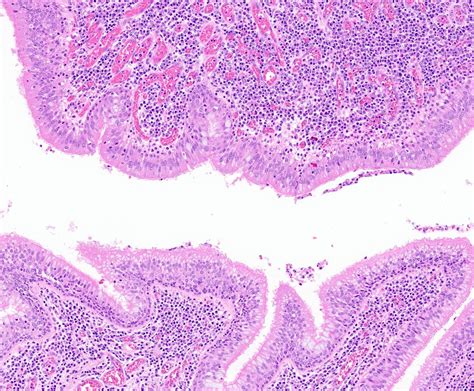 Pathology Outlines Bronchiectasis