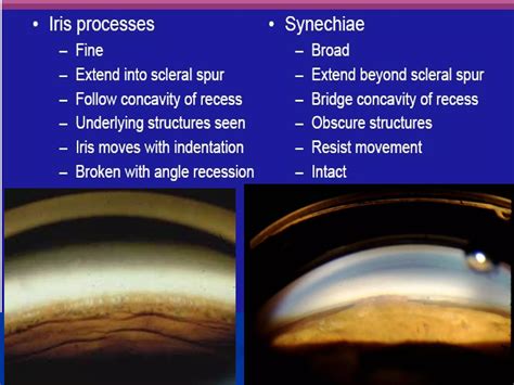 Gonioscopy Presentation Ppt